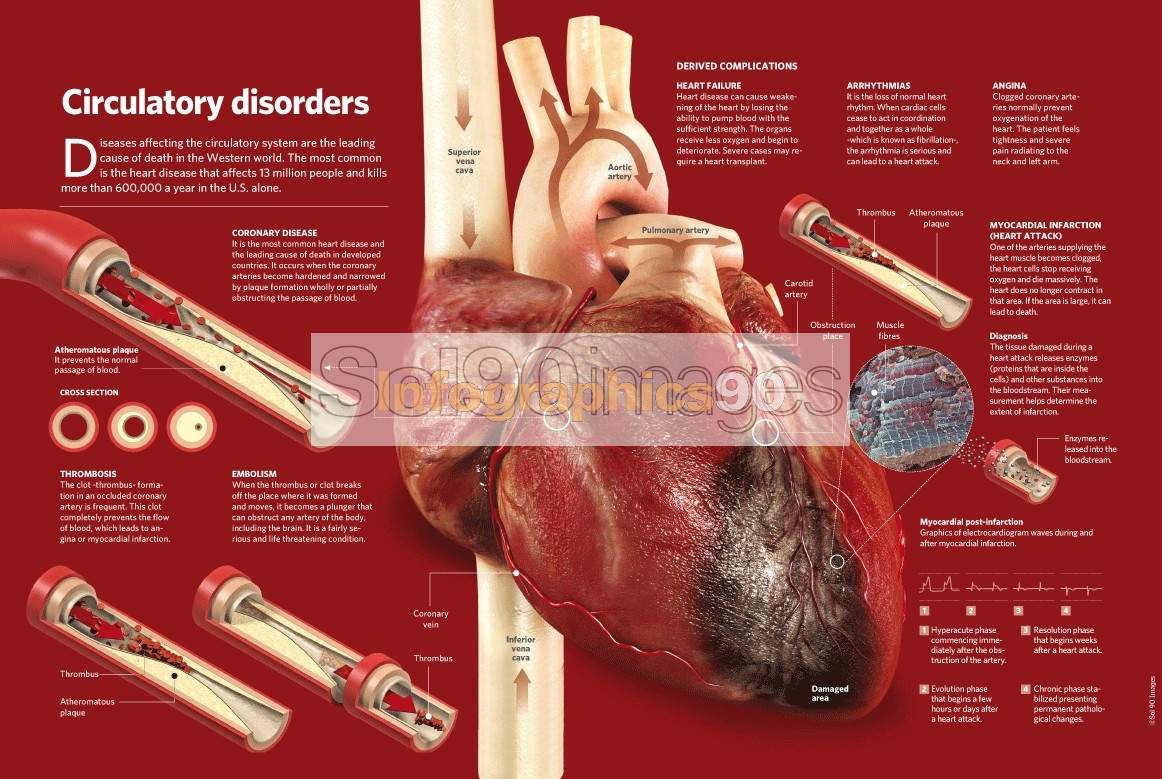 Infographics Circulatory Disorders | Sol90