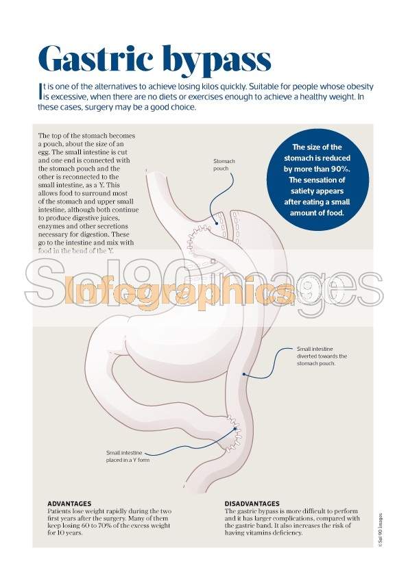 Infografía Baipás Gástrico | Infographics90