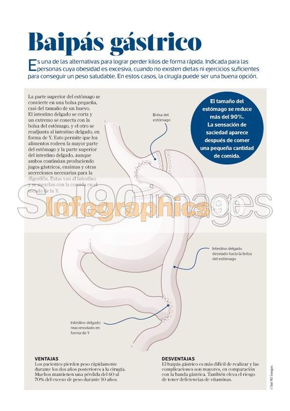 Infografía Baipás Gástrico | Infographics90